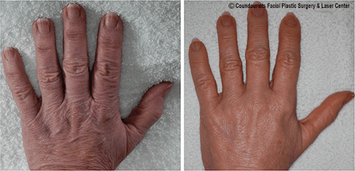 Hand Rejuvenation | Coundouriotis Facial Plastic Surgery & Laser Center